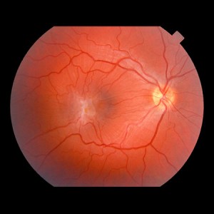 Epiretinal Membrane Treatment | Retina Macula Specialists of Miami