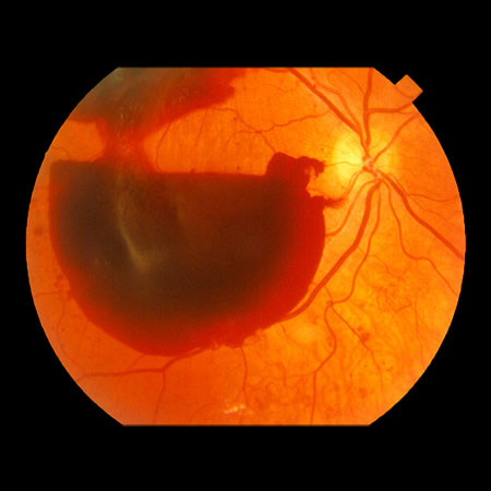 Vitreous Hemorrhage Treatment | Retina Macula Specialists of Miami